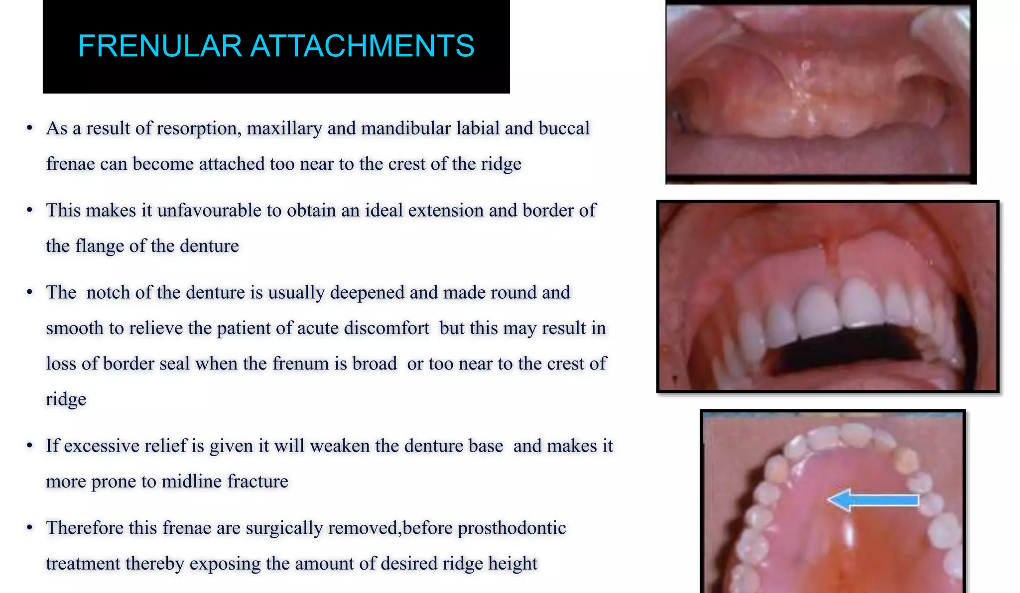 Methods to improve com[lete denture foundation 2 | PPTX