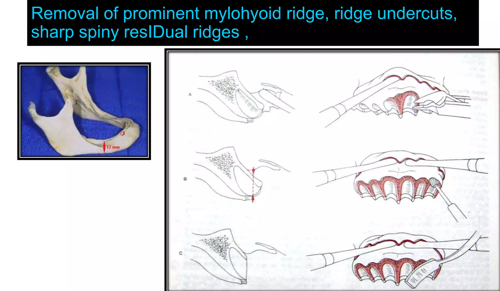 Methods to improve com[lete denture foundation 2 | PPTX
