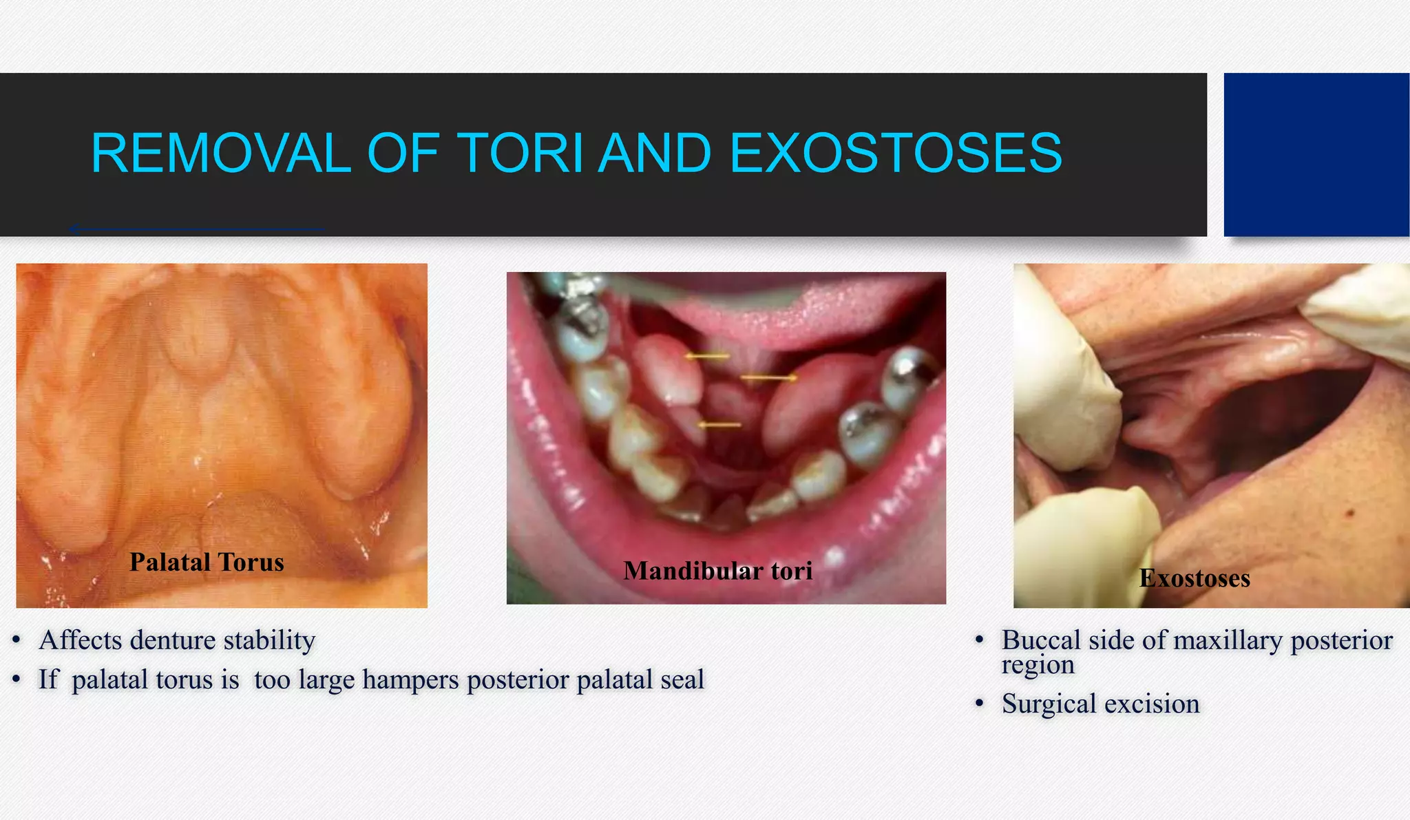 Methods to improve com[lete denture foundation 2 | PPTX