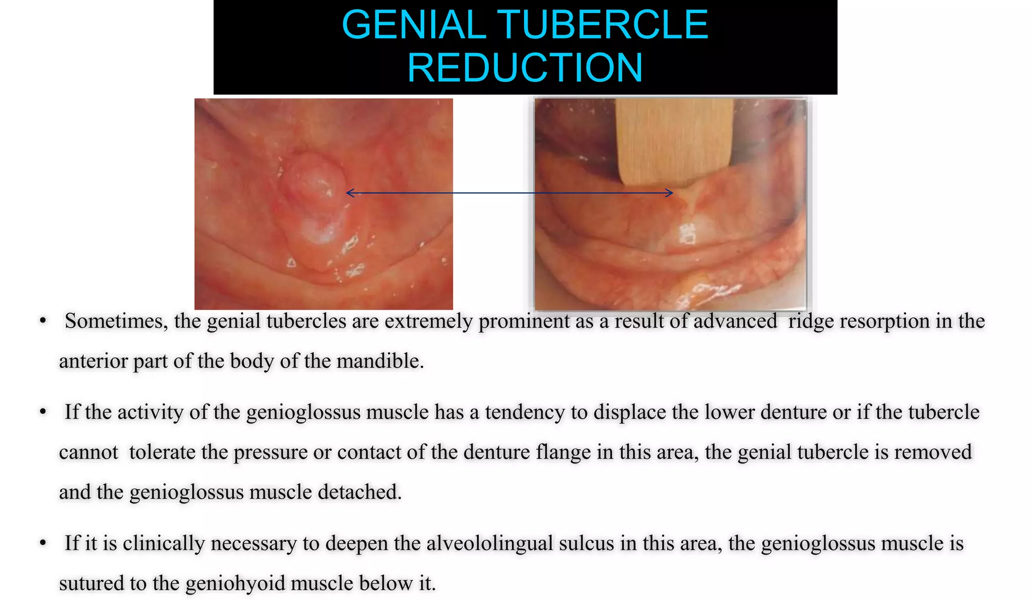 Methods to improve com[lete denture foundation 2 | PPTX