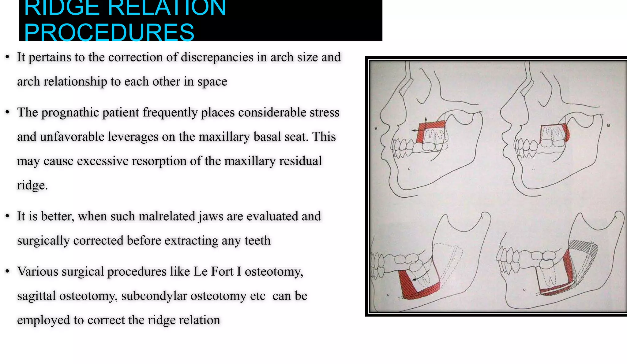 Methods to improve com[lete denture foundation 2 | PPTX