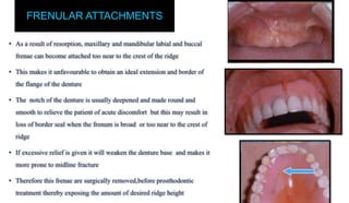Methods to improve com[lete denture foundation 2 | PPTX