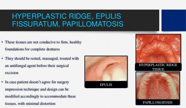 Epulis Fissuratum Histology