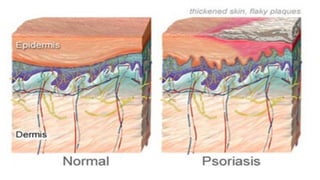 case study nMethotrexate toxicity and chronic plaque psoriasis.pptx