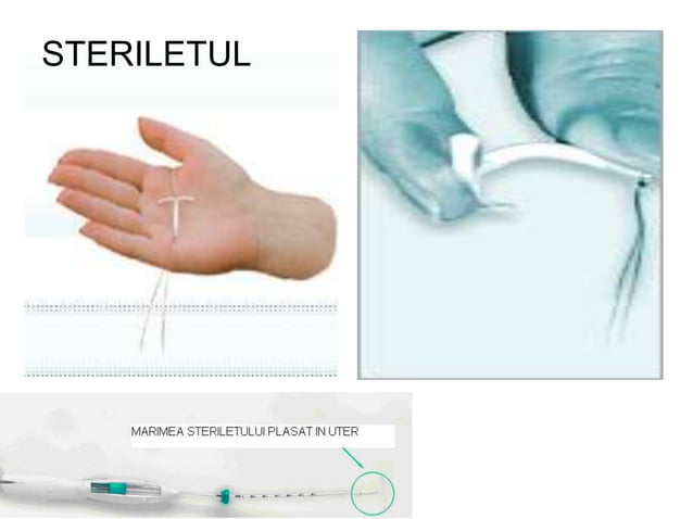 Metode contraceptive | PPT