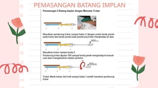METODE KONTRASEPSI IMPLAN PRESENTATION.pptx