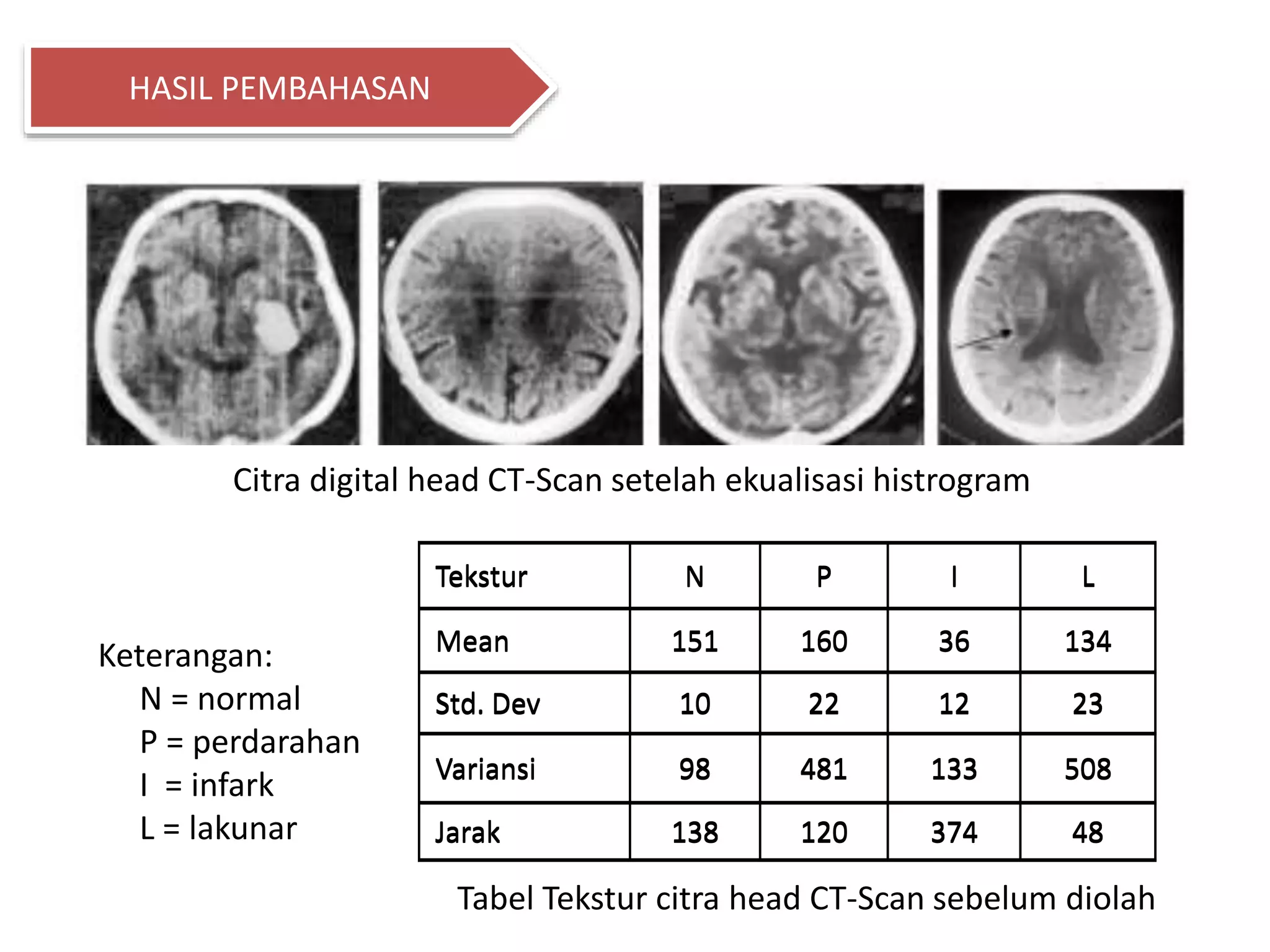 METODE SEGMENTASI UNTUK ANALISIS CITRA DIGITAL HEAD CT-SCAN | PPTX