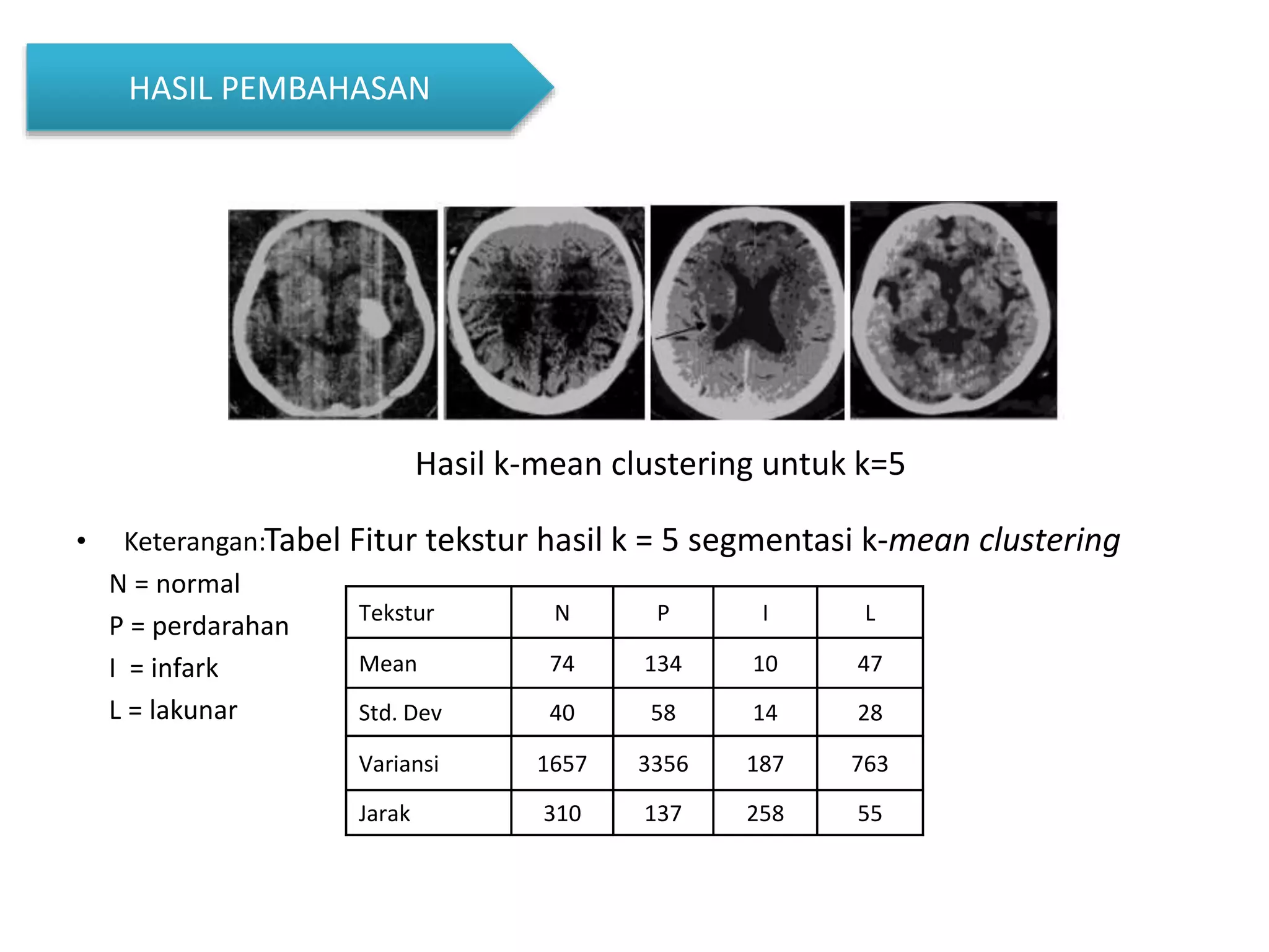 METODE SEGMENTASI UNTUK ANALISIS CITRA DIGITAL HEAD CT-SCAN | PPTX