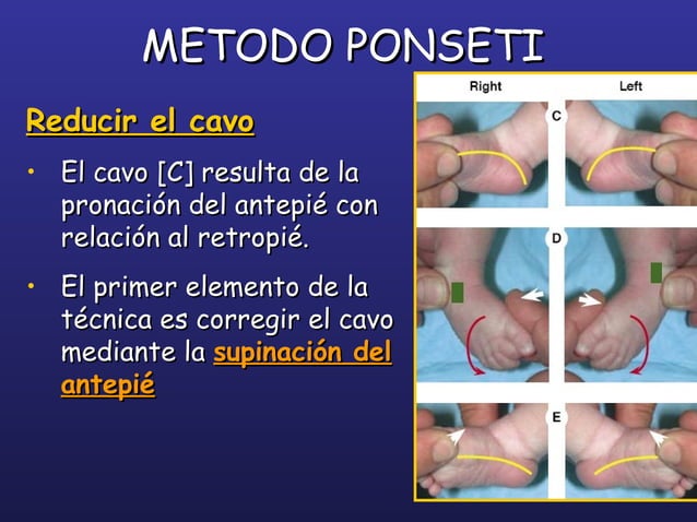 Método ponseti | PPT