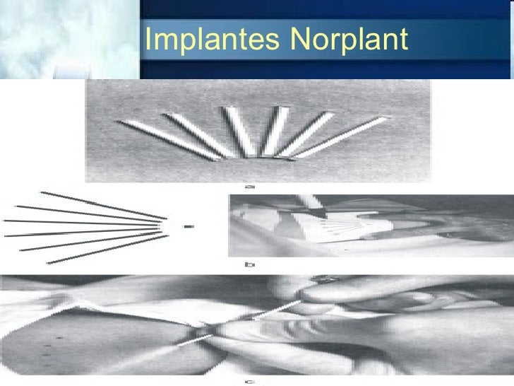 Metodos Anticonceptivos