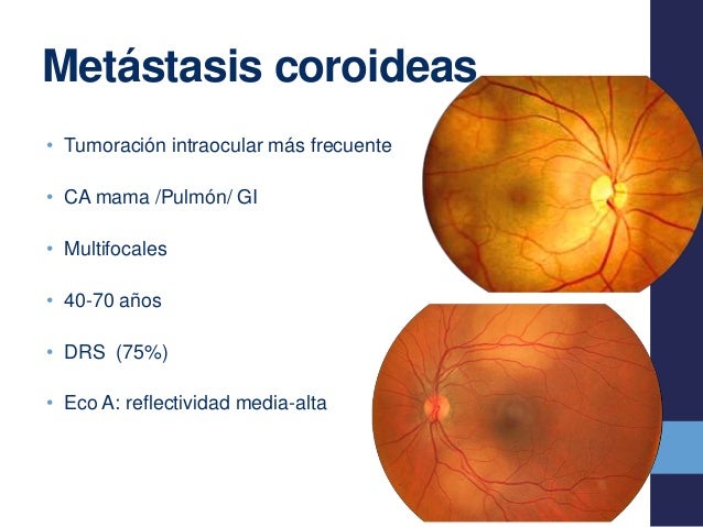 Metastasis a coroides