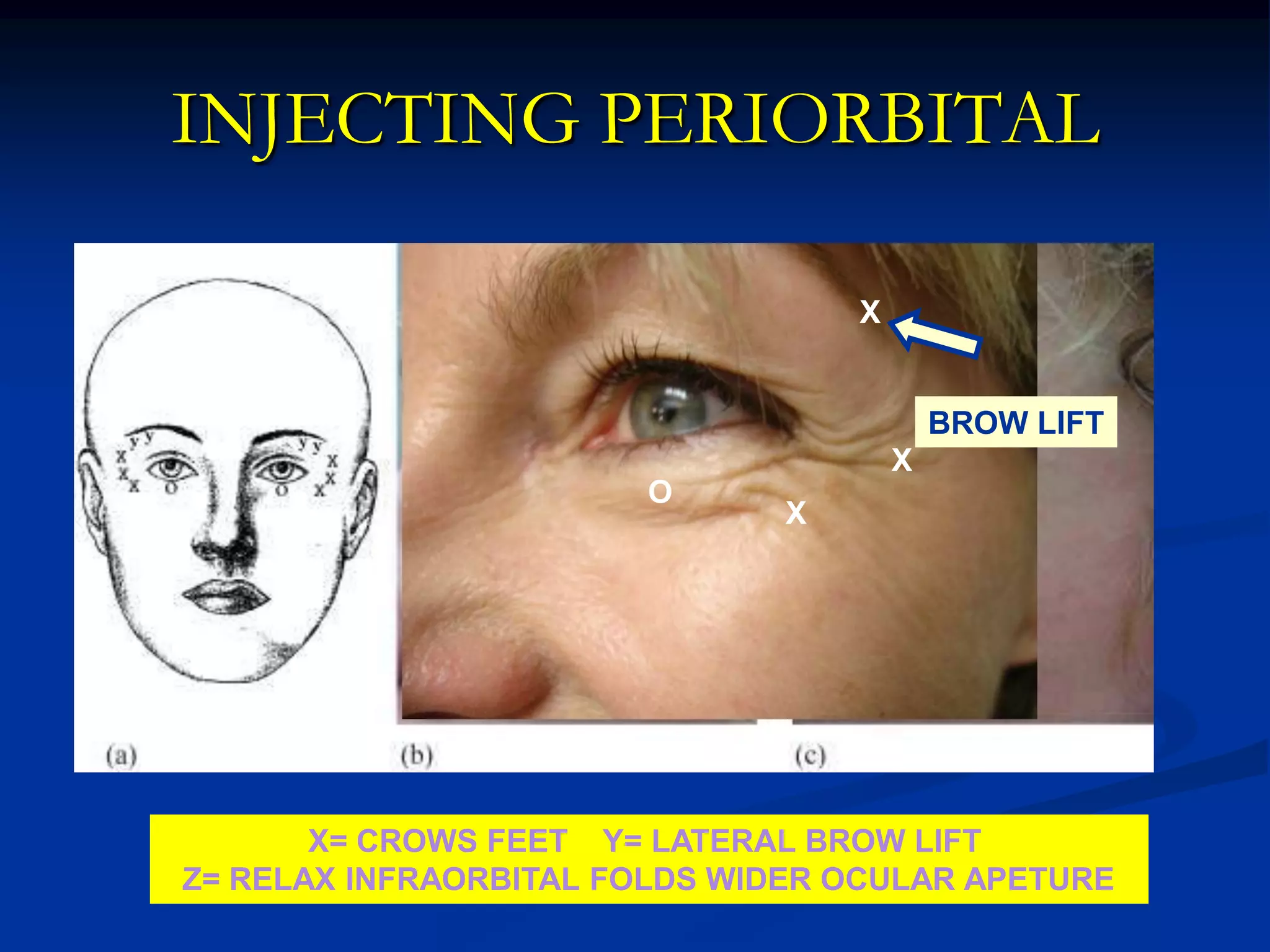 Using Botox for Periorbital Rejuvenation