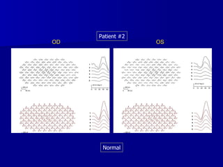 Multifcoal ERG in Hydroxychloroquine Retinopathy | PPT
