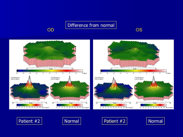 Multifcoal ERG in Hydroxychloroquine Retinopathy