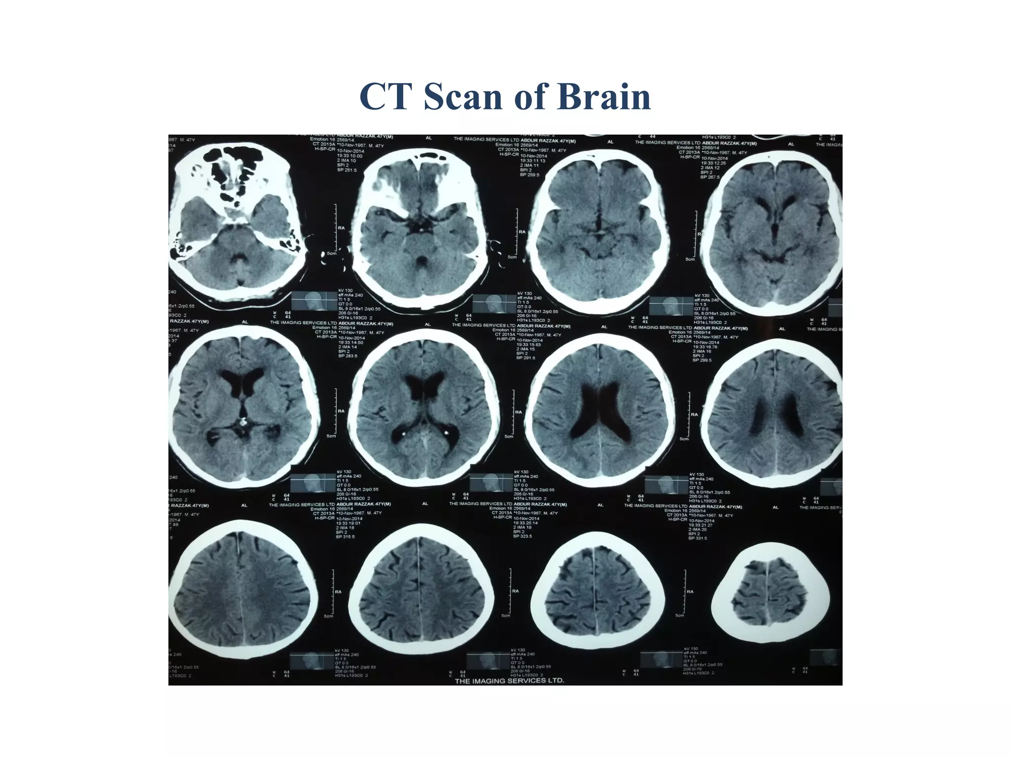 Miller fisher syndrome | PPT