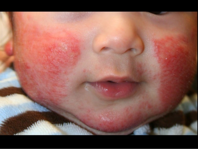 Mga karaniwang sakit sa balat