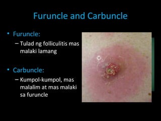 Mga sakit sa balat sanhi ng bacteria | PPT