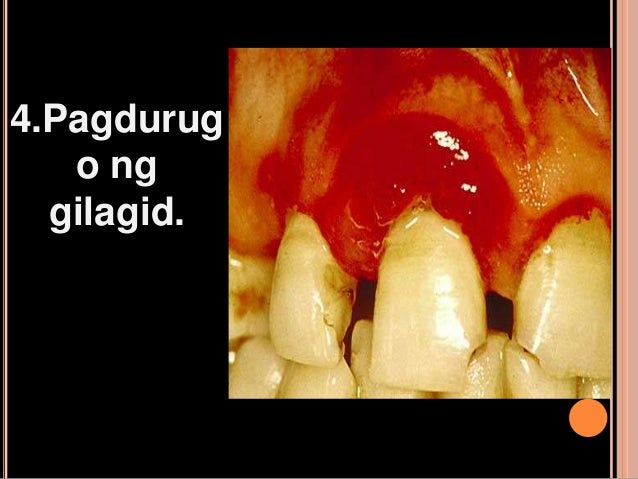 MGA SAKIT SA BIBIG by Lorraine Anoran