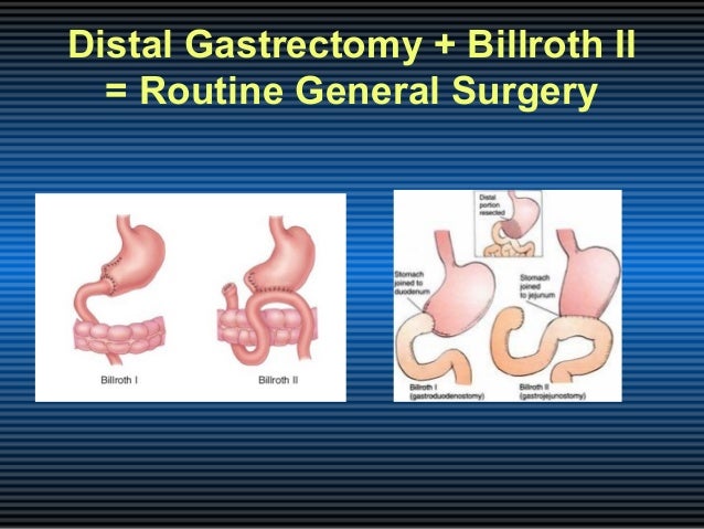 Billroth 2 Anatomy