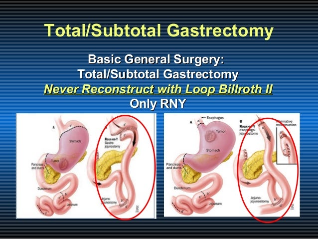 Total Gastrectomy Anatomy