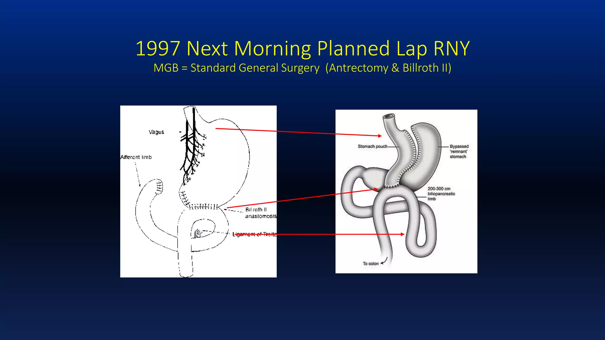 Mgb billroth II Hx | PPTX