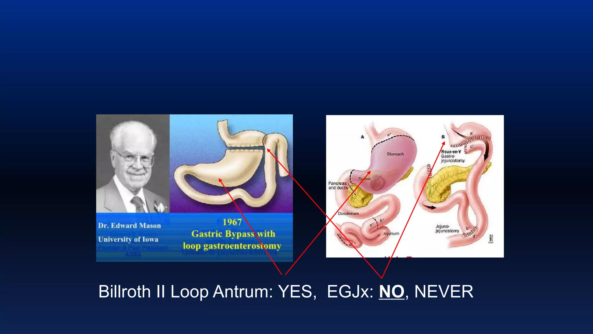 Mgb billroth II Hx | PPTX