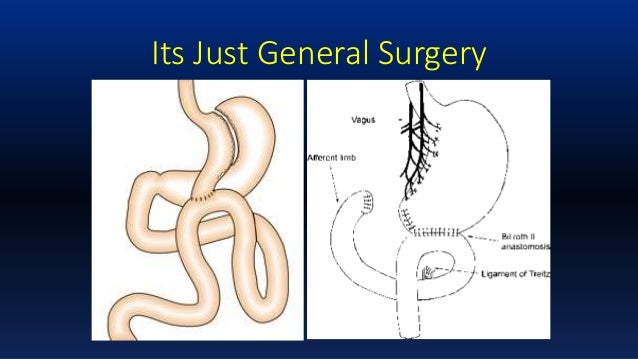 Billroth Surgery