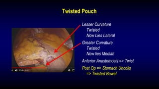 Mgb twisted pouch syndrome | PPTX