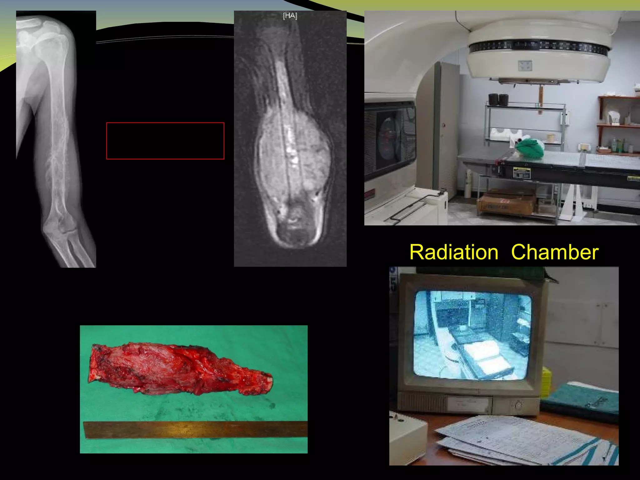 ROLE OF RADIATION IN BONE TUMORS FOR ORTHOPEDICS | PPT | Cancer ...