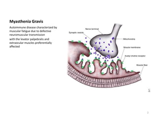 MG comparison, Ocular vs General | PPTX