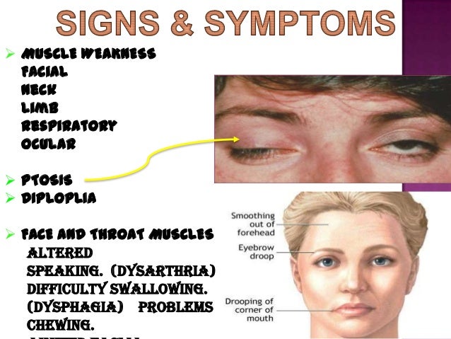 Myasthenia gravis