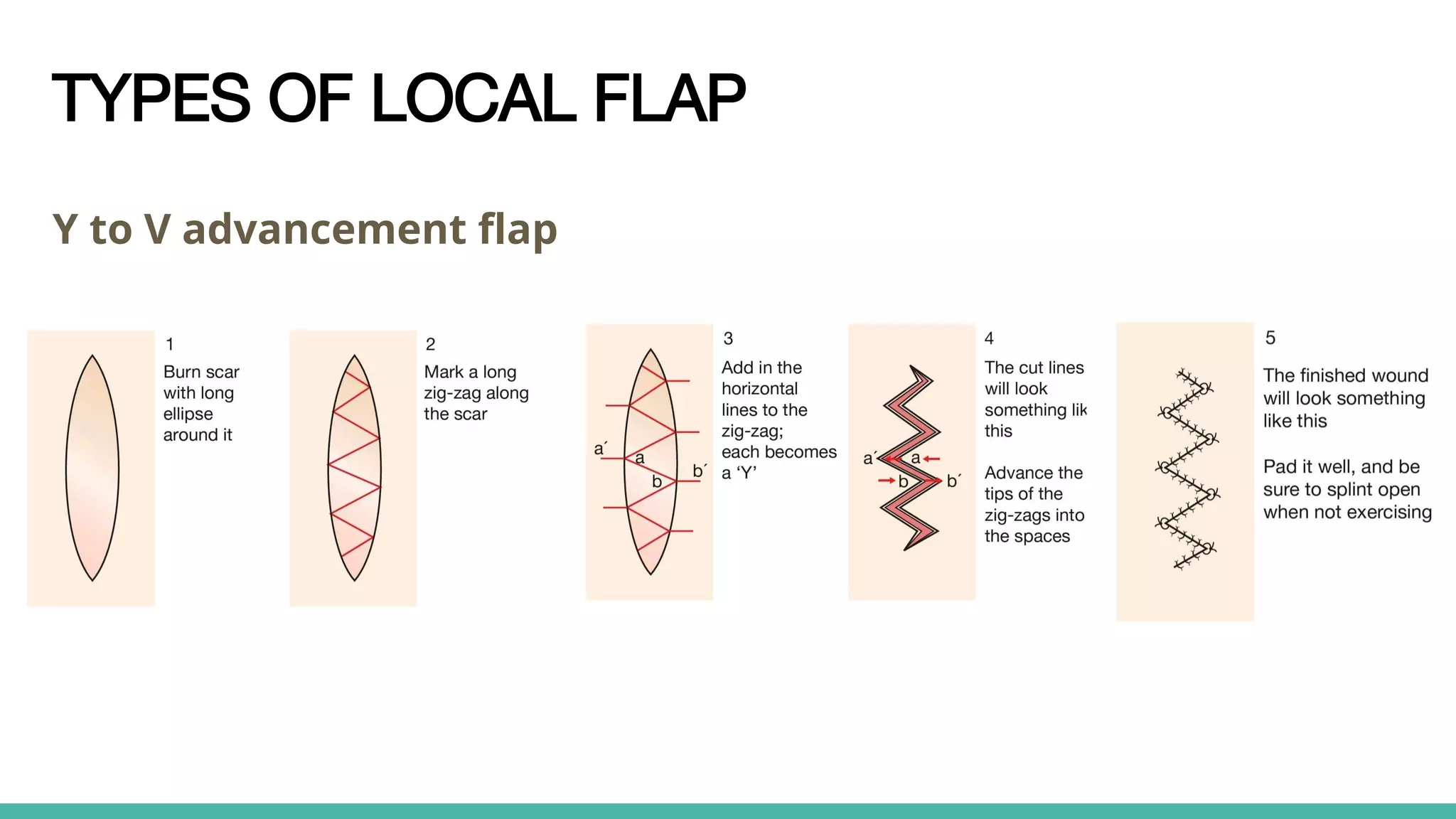 Different types of Skin graft & flap.pptx