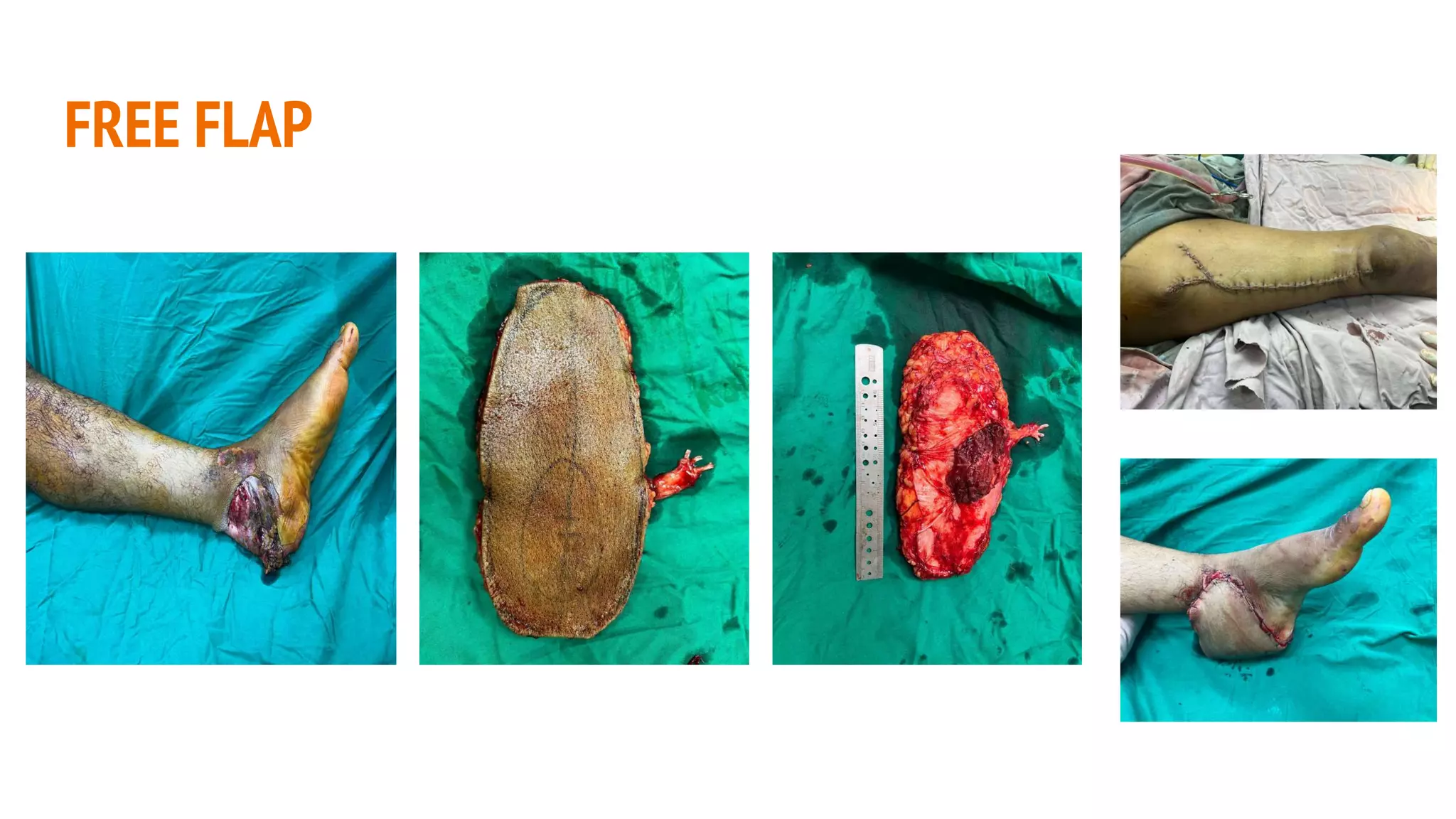 Different types of Skin graft & flap.pptx