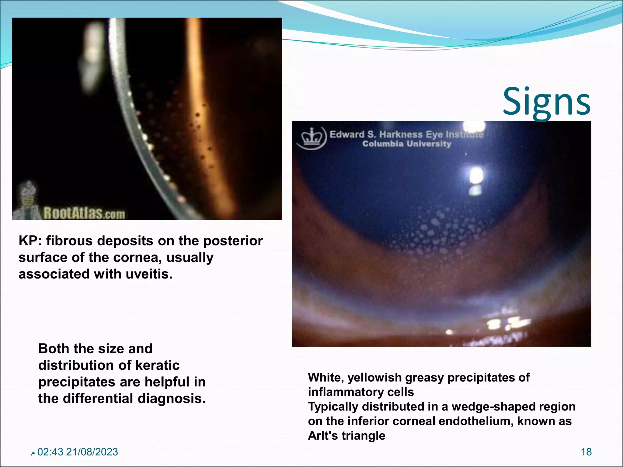 lecture_on_anterior_uveitis_new.ppt
