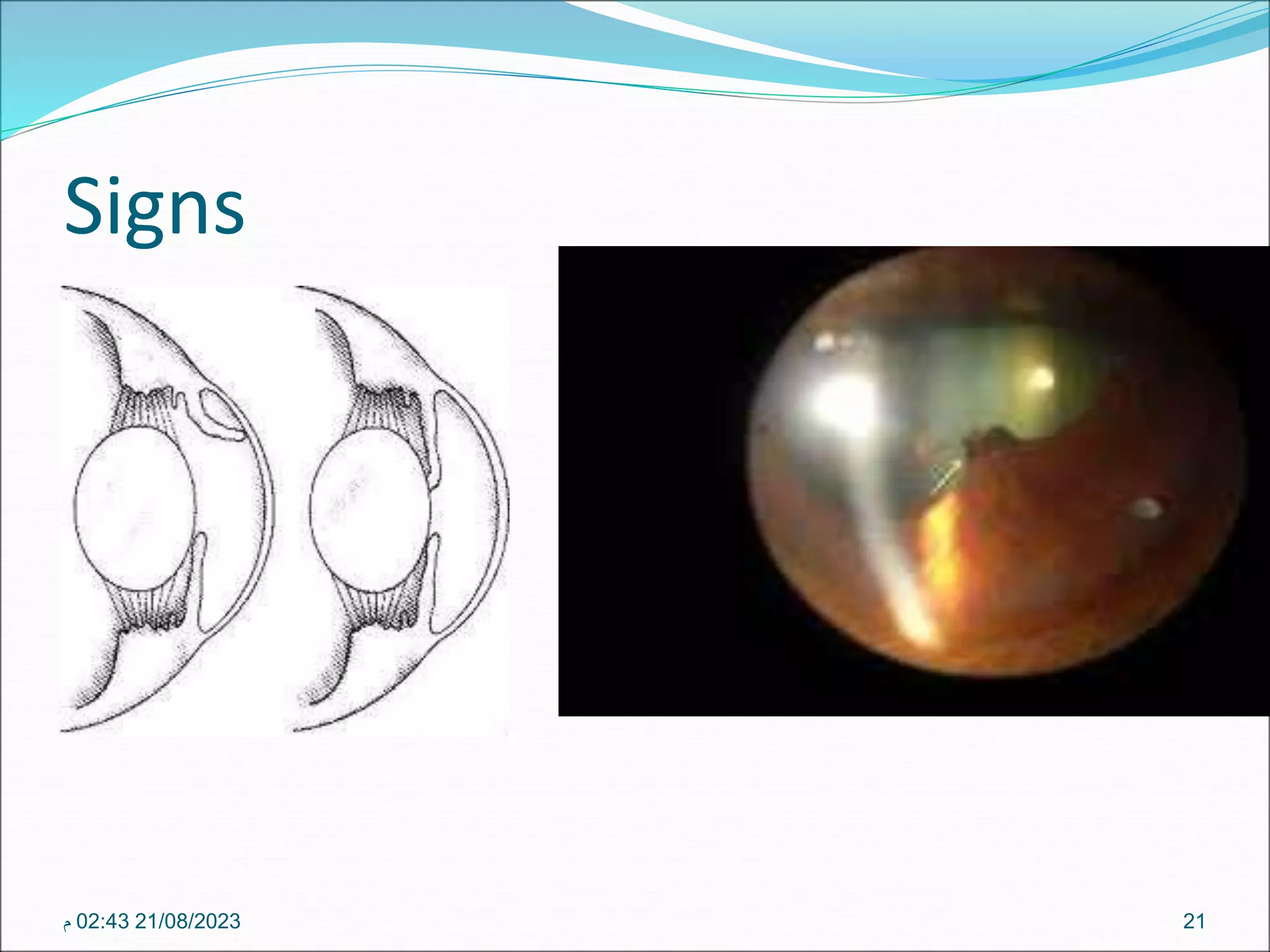 lecture_on_anterior_uveitis_new.ppt