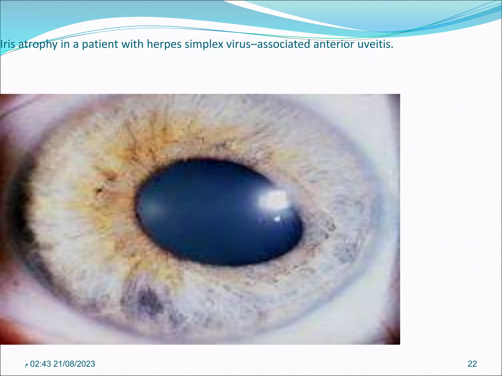 lecture_on_anterior_uveitis_new.ppt