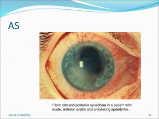 lecture_on_anterior_uveitis_new.ppt