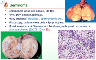 Pathology of Testes tumours | PPTX