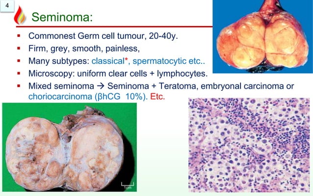 Pathology of Testes tumours | PPTX | Reproductive Health | Diseases and ...