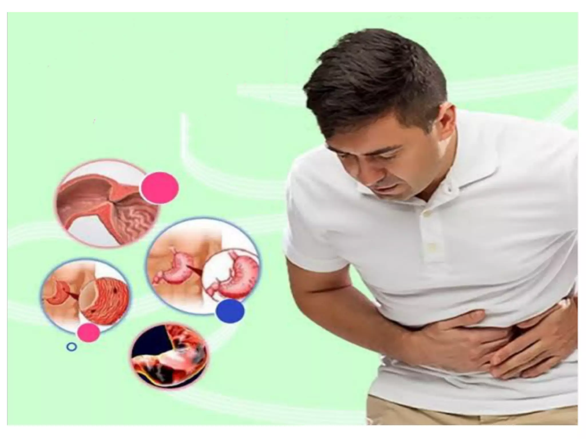 Management of Acute Exacerbation of Peptic Ulcer Disease (PUD) | PDF