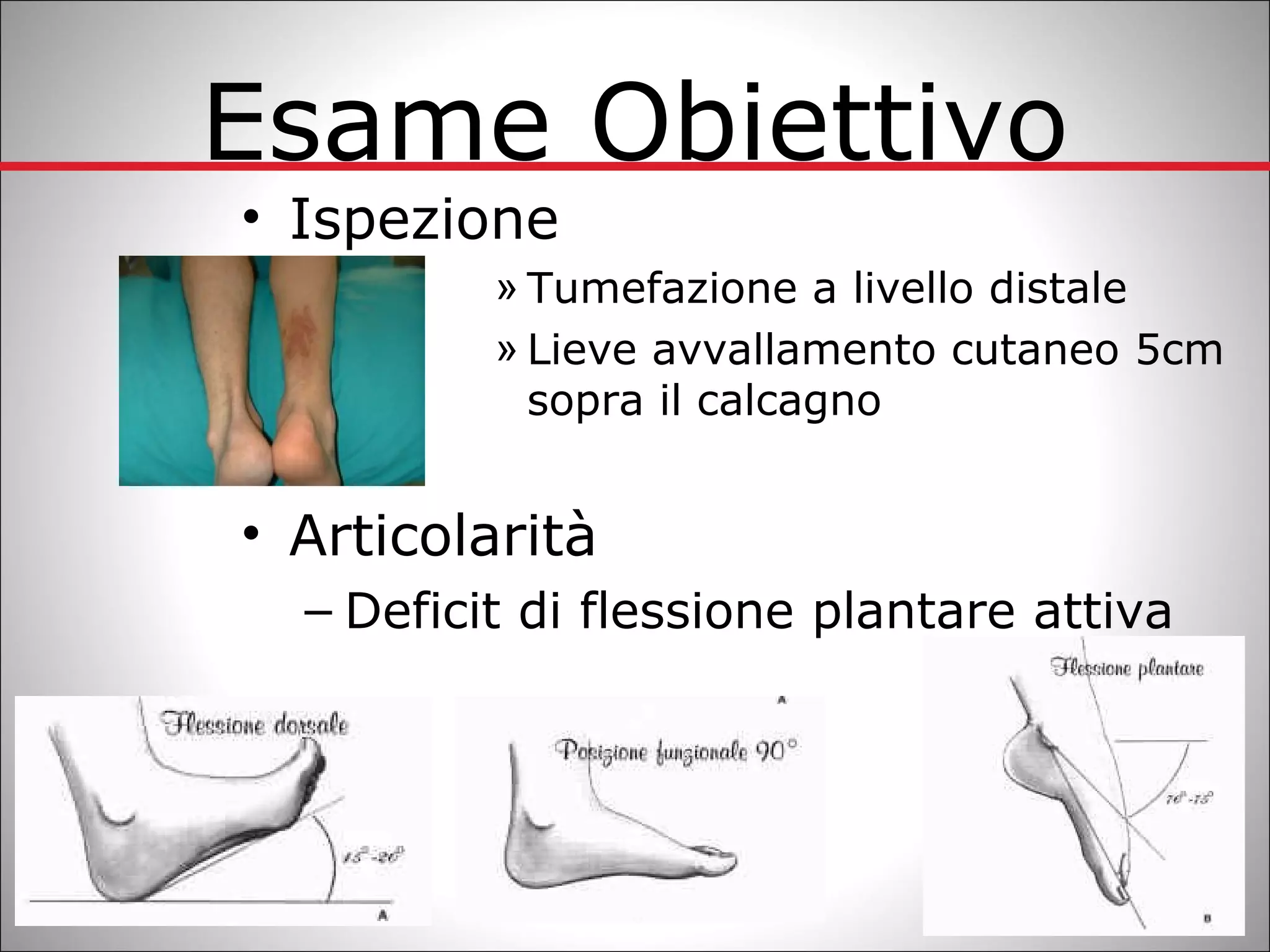 Caso clinico di rottura tendine di Achille | PPT