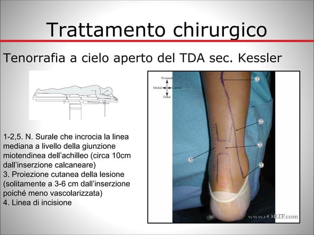 Caso clinico di rottura tendine di Achille | PPT