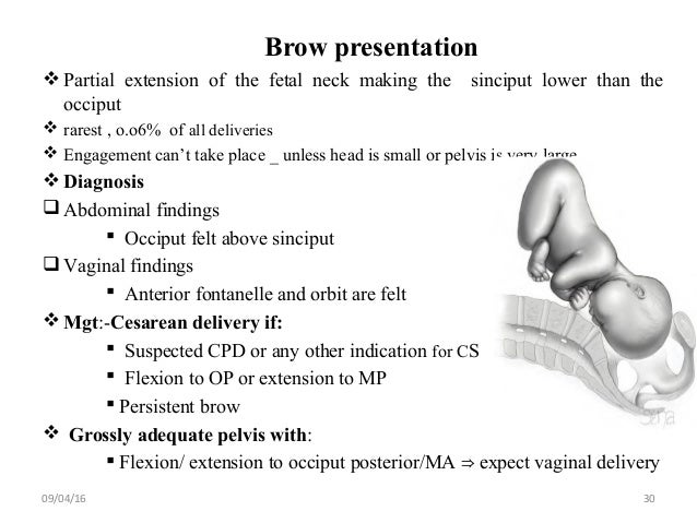 Brow Is A Abnormal Presentations Of Fetus Abnormal Fetal Positions,