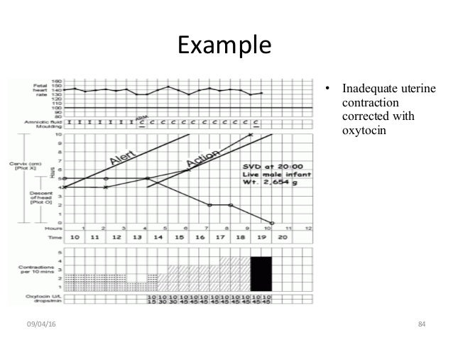 Mgt of abnormal labor & partograph
