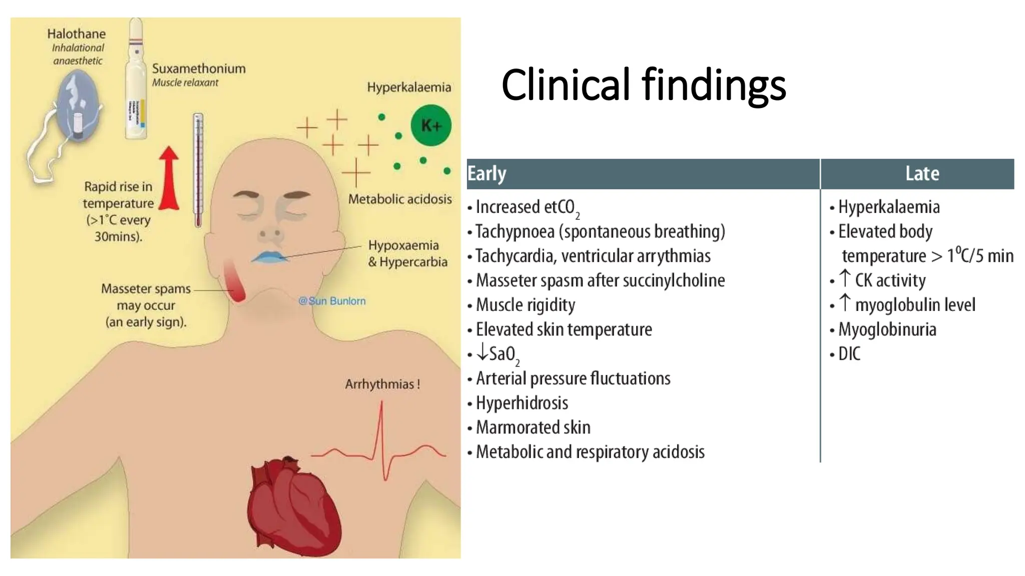 malignant hyperthermia anaesthesia point of view | PPTX