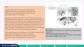 The Role Of Neurointervention In Acute Ischemic Stroke | PPTX