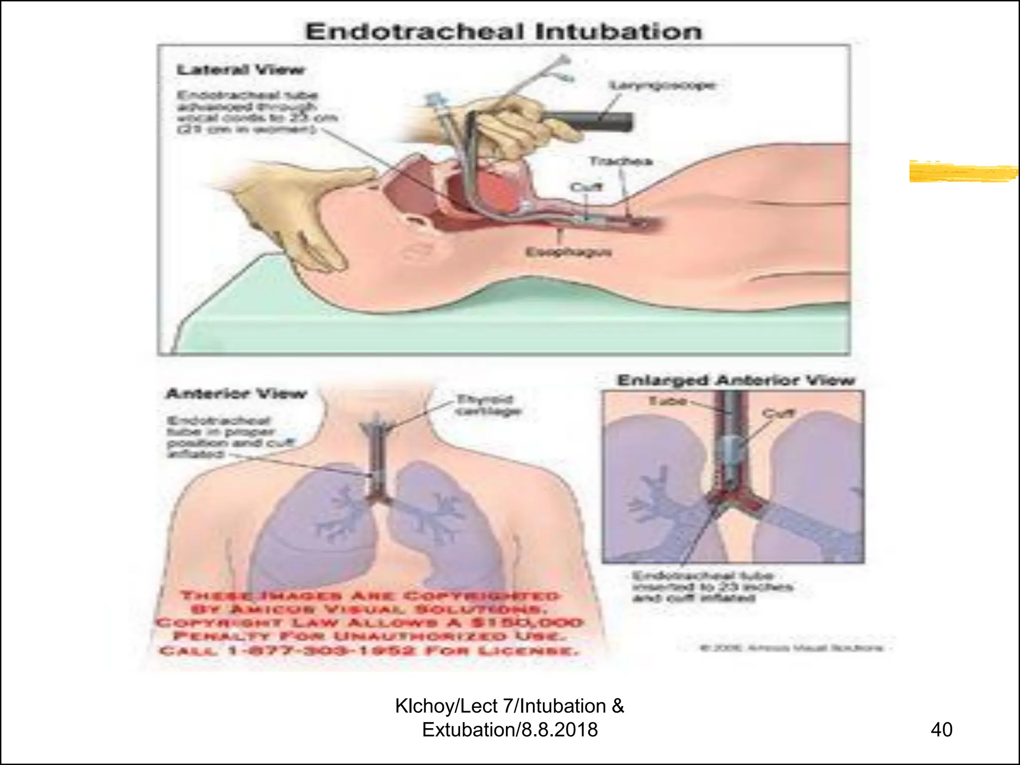 MHG1004-Lect 6-Assisting Dr in Definitive Airway Mx-intubation & extubation(8.8.2024).pdf