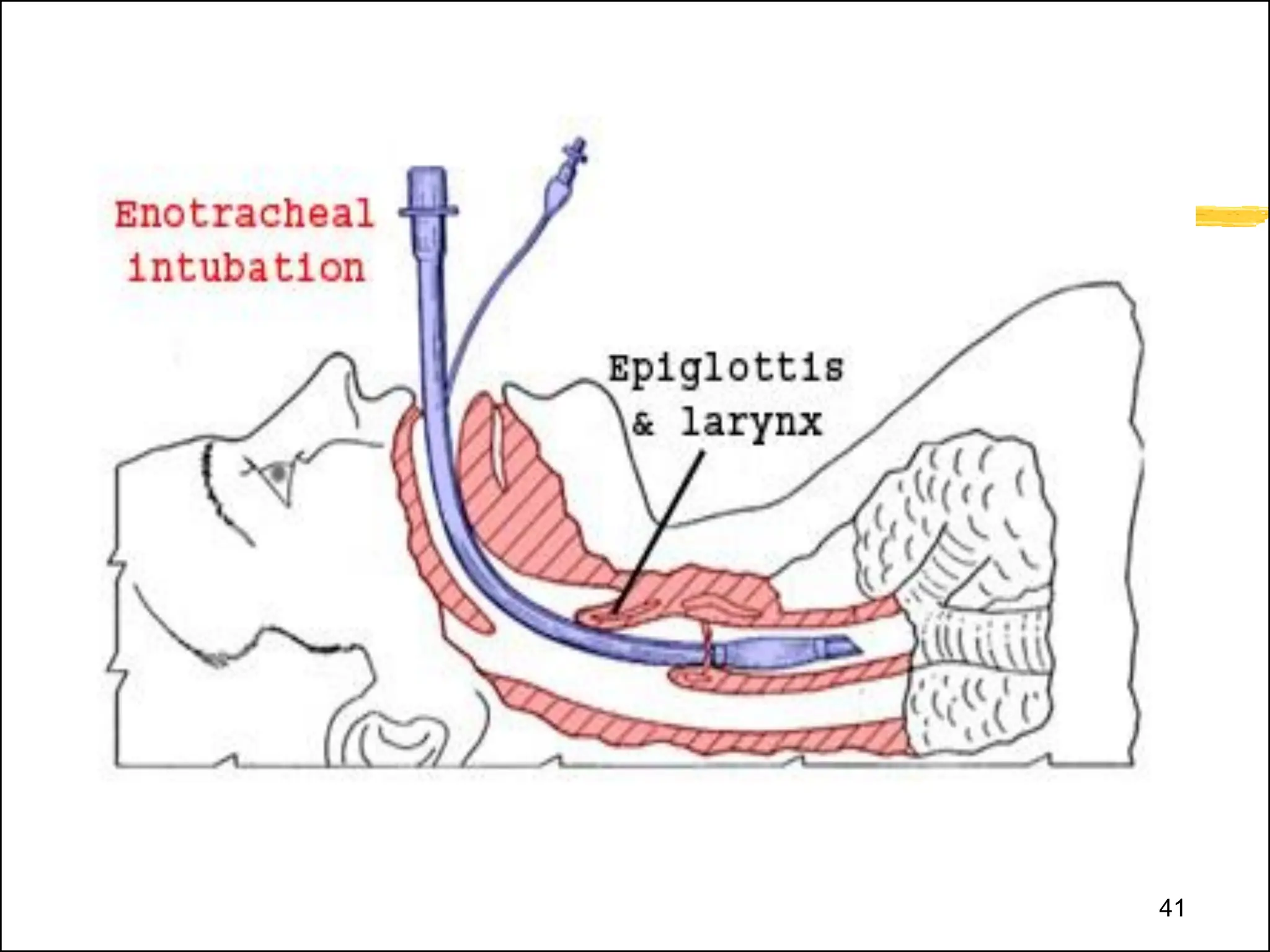 MHG1004-Lect 6-Assisting Dr in Definitive Airway Mx-intubation & extubation(8.8.2024).pdf