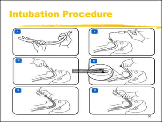 MHG1004-Lect 6-Assisting Dr in Definitive Airway Mx-intubation ...