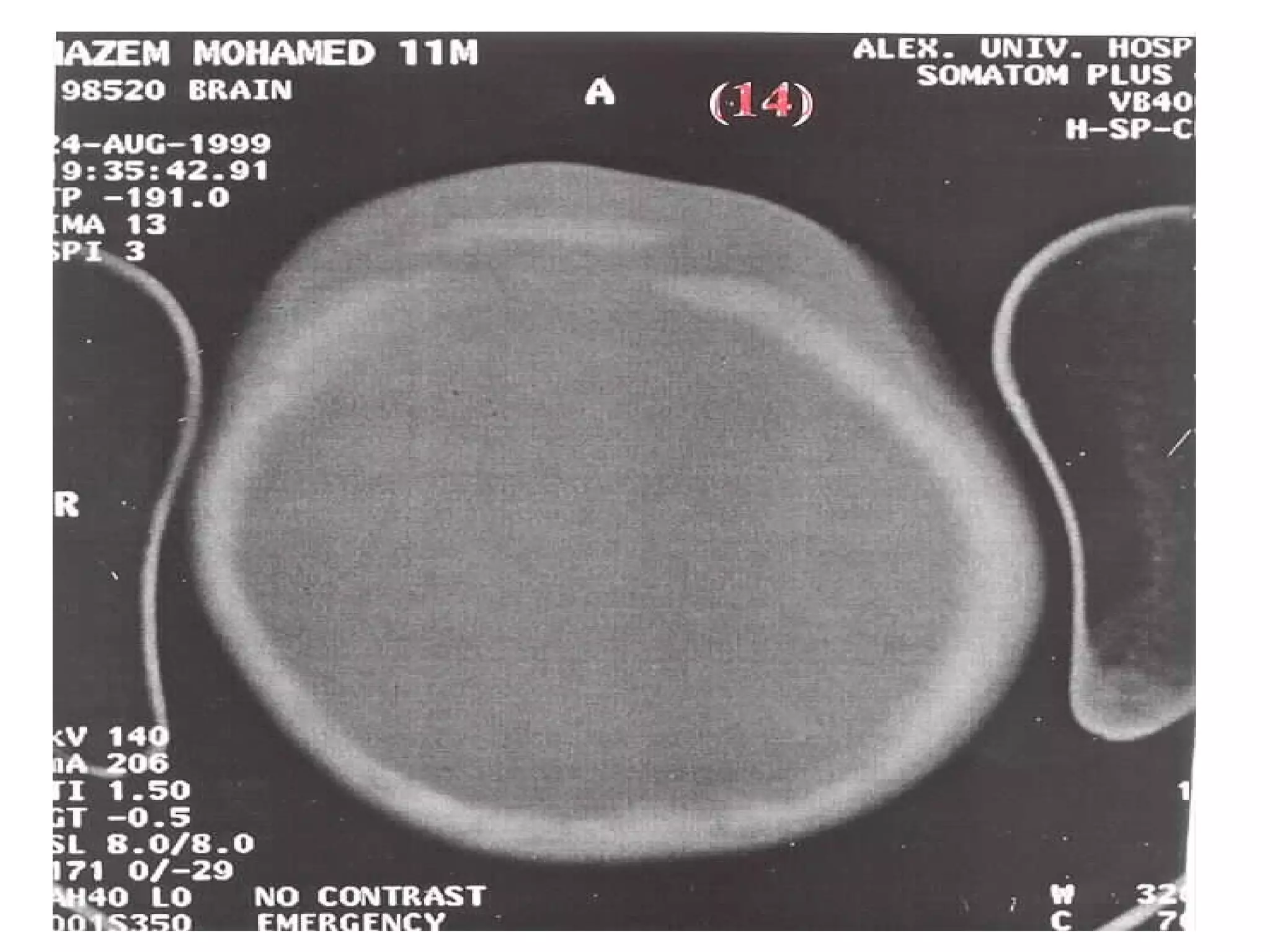 Minor and moderate head injuries in children | PPT
